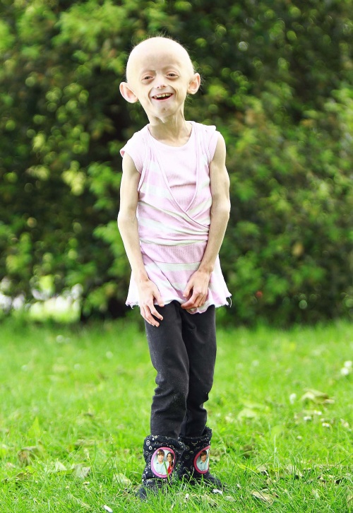 Progeria: Vezi GALERIA FOTO cu boala necruţătoare | Unica.ro